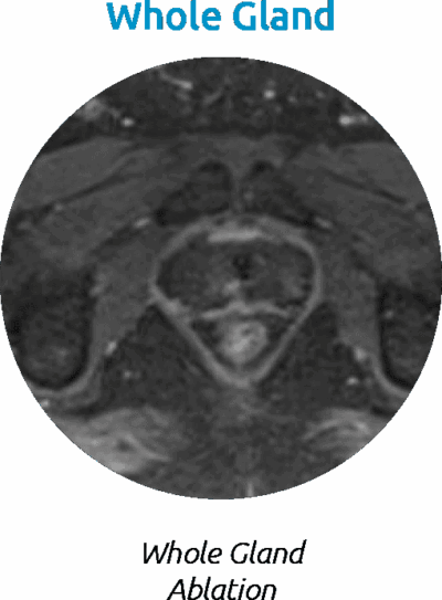 Vanquish - Francis Medical