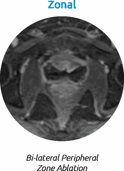 Vanquish - Francis Medical